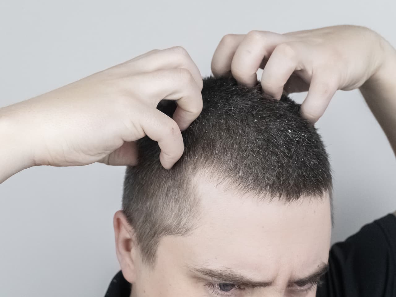 Alopecia Scalp Pain: Why It Happens and How to Treat It – RootMD