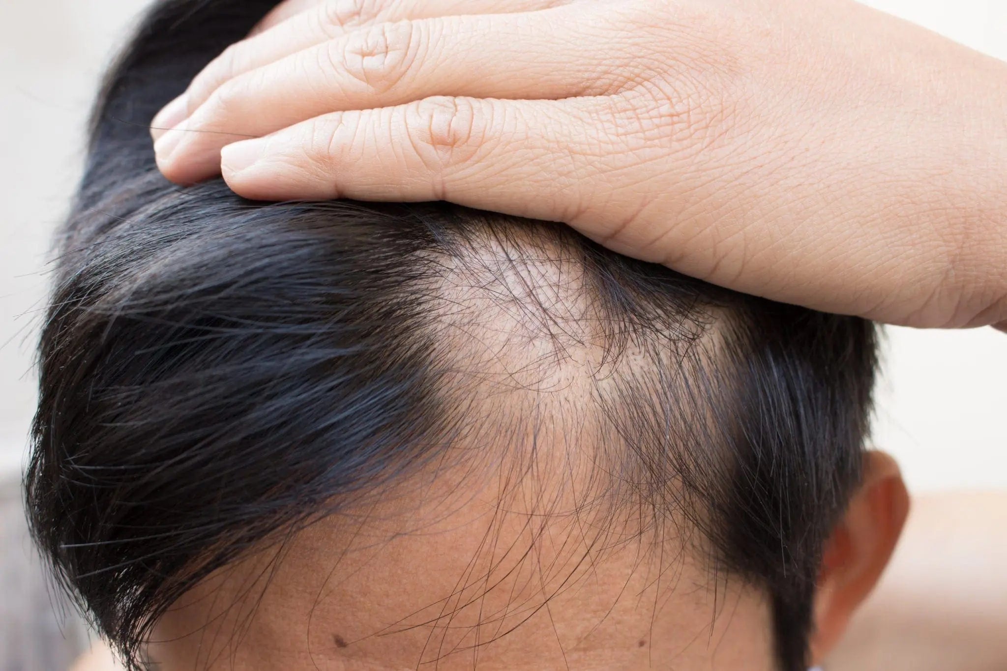 Why Am I Balding at 18? Expert Answers and Real Solutions – RootMD