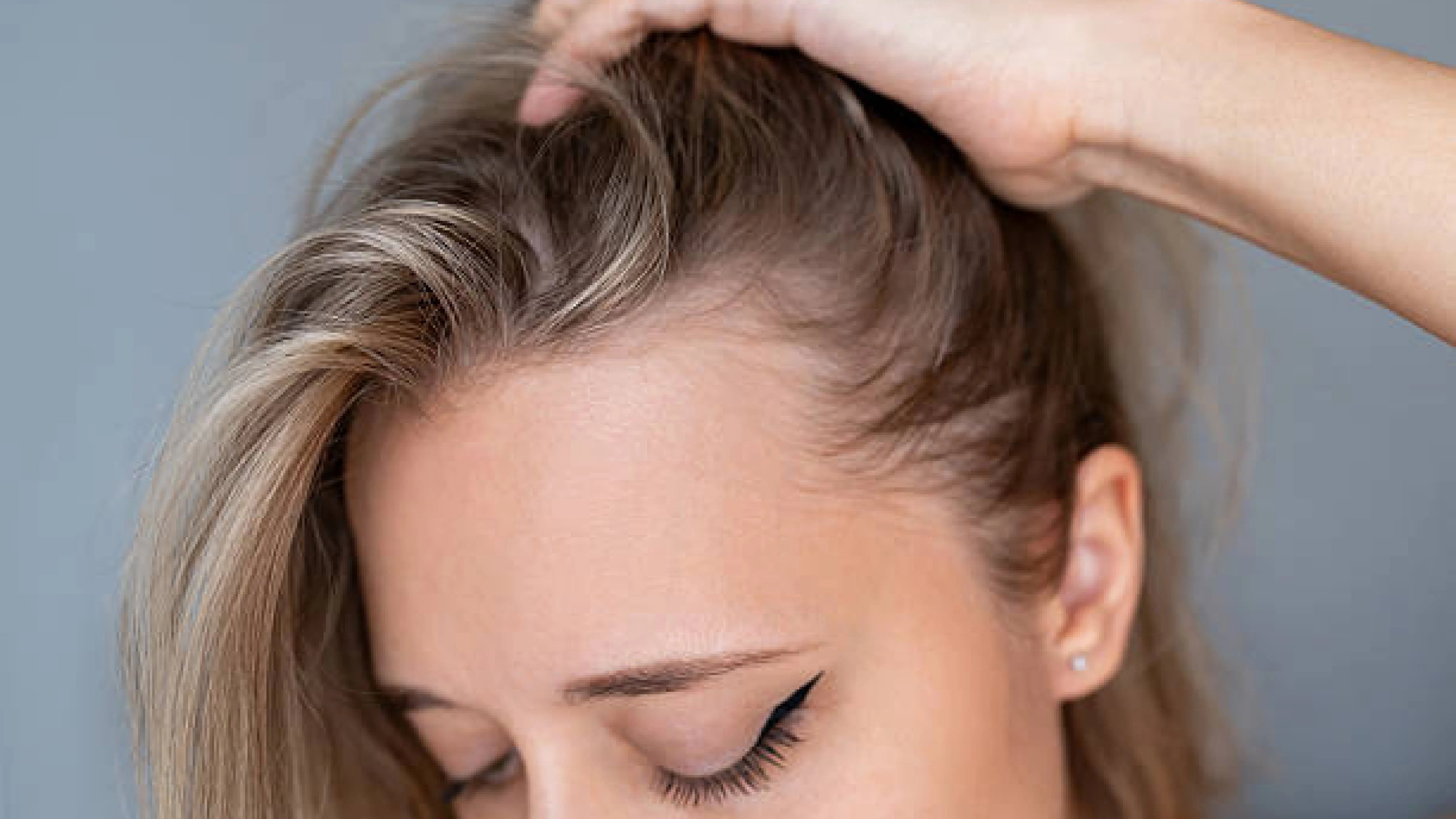Hair Thinning in Females at the Temples – A Complete Guide for Women ...